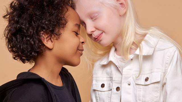 Albinisme : comprendre cette maladie génétique rare et ses conséquences ...